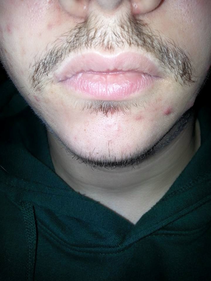 19 year old, advice? UPDATE!! (3RD UPDATE!) - Beard Board 19 year old, advice? UPDATE!! (3RD UPDATE!) - Beard Board