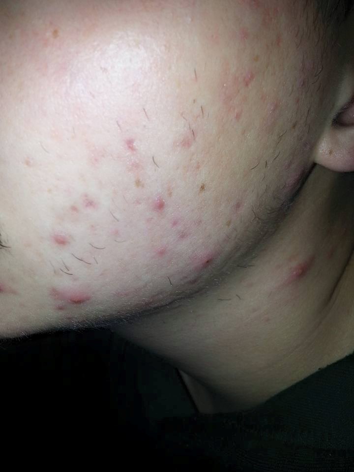 19 year old, advice? UPDATE!! (3RD UPDATE!) - Beard Board 19 year old, advice? UPDATE!! (3RD UPDATE!) - Beard Board